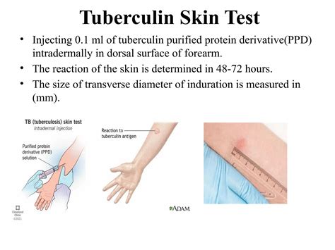 Diagnosis Of Tuberculosis General Medicine Pptx