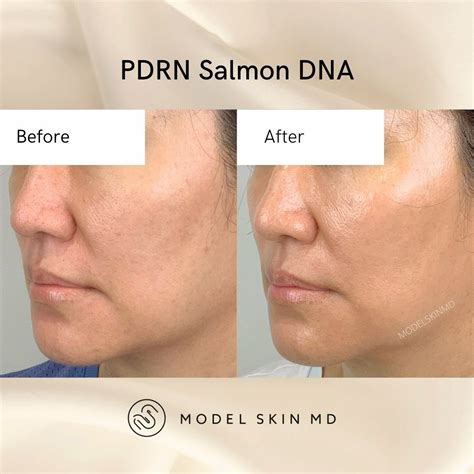 Pdrn Salmon Dna Skin Booster Treatment Vancouvers Aesthetic Cosmetic