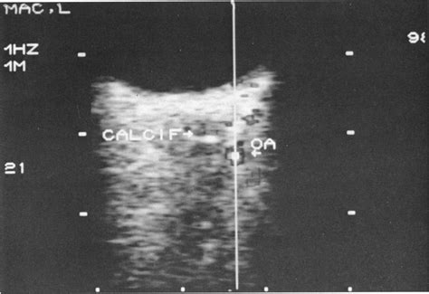 Higher Magnification Of Fig 4 Showing Calcific Embolus Within