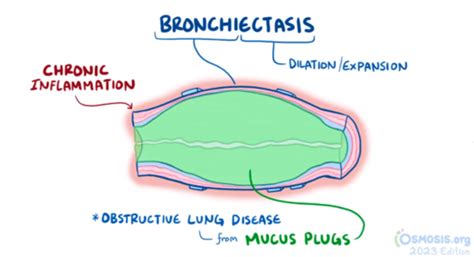 Pulmonary Bronchiectasis And Cystic Fibrosis Flashcards Quizlet