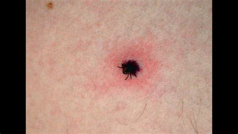 How To Remove Tick Deep In Skin At Hazel Anderson Blog