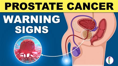 Warning Prostate Cancer Signs What You Need To Know About Prostate