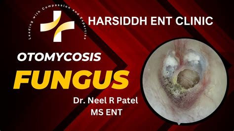 Otomycosis Fungus In Ear Check The Description Now👉 Youtube