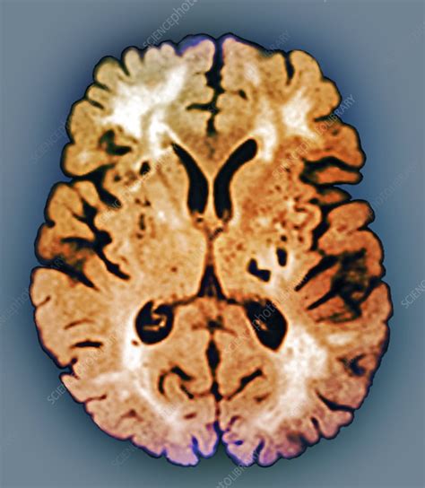 Cadasil Syndrome Mri Scan Stock Image C0071975 Science Photo Library