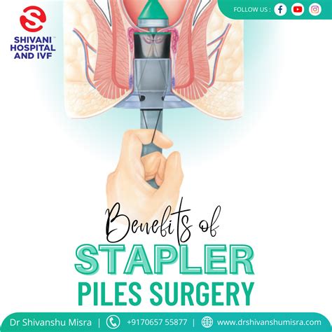 Benefits Of Stapler Piles Surgery Dr Shivanshu Misra Facebook