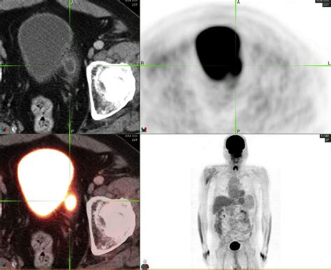 77 Year Old Male With Bladder Diverticulitis Followup Petct