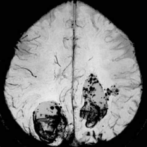 Brain Magnetic Resonance Susceptibility Weighted Imaging After