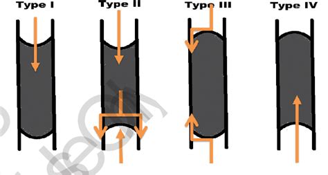 Figure 1 From Learn How Access Strategy Impacts Complex Cto Crossing