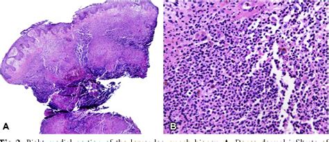 Figure 2 From Pyoderma Gangrenosum In A Patient With Cutaneous T Cell
