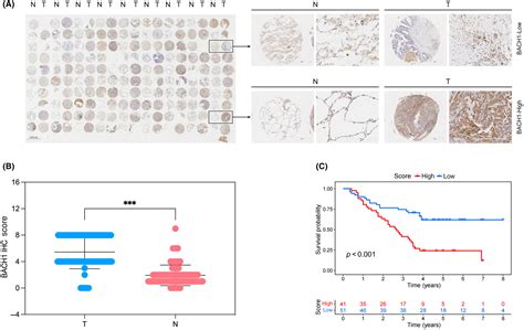 Bach1 Promotes Lung Adenocarcinoma Cell Metastasis Through
