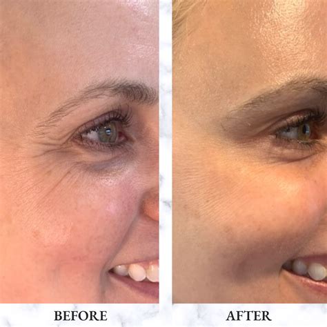 Botox — Peak Aesthetics