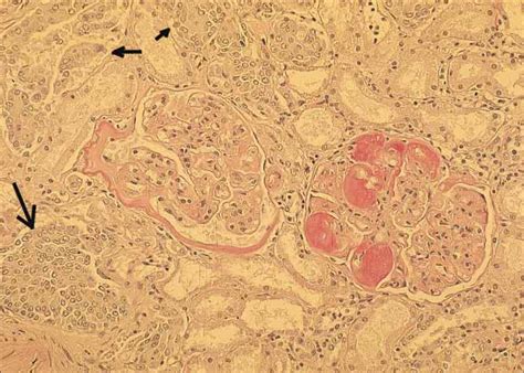 Renal Cortex Showing Large Glomerular Hyaline Nodules Right