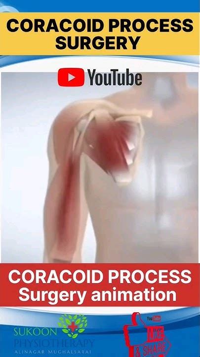 Tendon Transplant And Coracoid Process Surgery Shorts Short Tendons