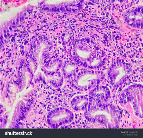 Inflammation Of The Gastric Mucosa Over 228 Royalty Free Licensable