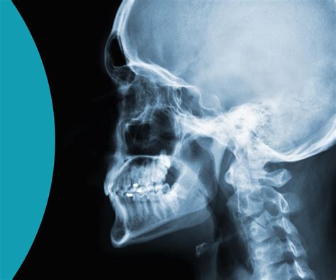 Mandibulectomy Head And Neck Surgery London