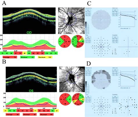 A Rnfl Analysis Of The Right Optic Nerve By Spectral D Oct At The 6th