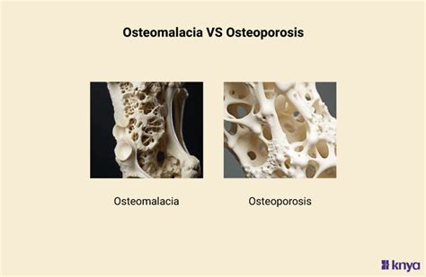 Osteomalacia Em Adultos