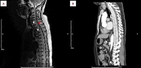 A A T2 Phase Sagittal View Showing A Fusiform Lesion Involving The