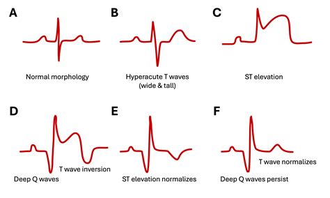 Myocardial Ischemia And Infarction Ekg Essentials A Student Handbook