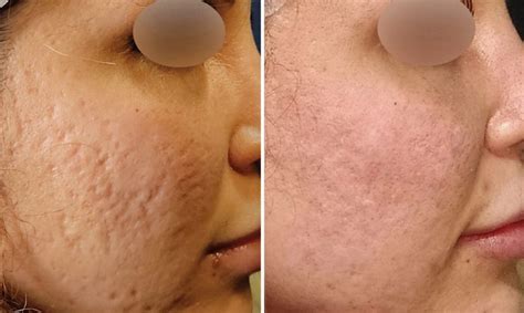 Microneedling Rf And Rf Laser For Acne Scars Effective Treatments That Work