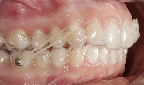 ¿qué Efecto Tienen Los Elásticos En Incisivos Inferiores Con Brackets Y Alineadores Common