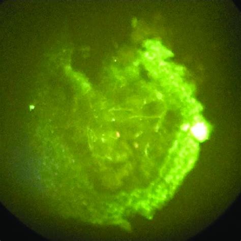 Direct Immunofluorescence Showing Bright Intercellular Deposition Of