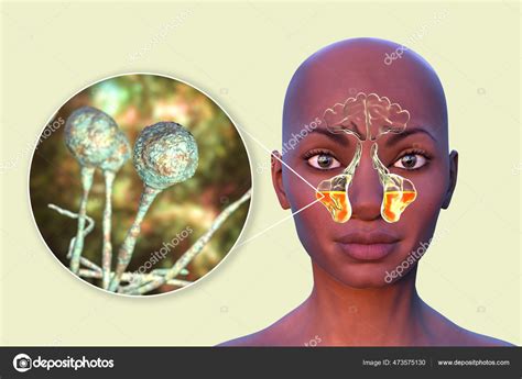 Mucor Fungi Cause Sinusitis Illustration Inflammation Maxillary Sinuses