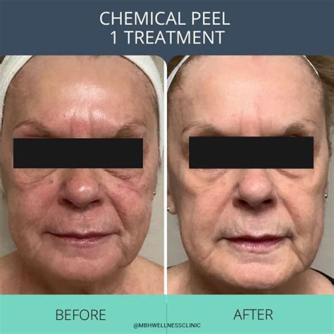 Day By Day Chemical Peel Recovery The Ultimate Guide