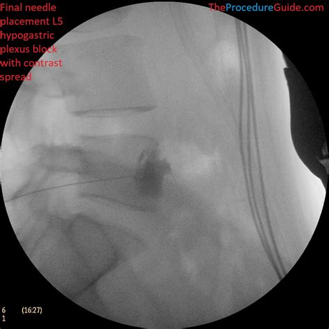 Fluoroscopic Guided Celiac Plexussplanchnic Nerve Block Technique