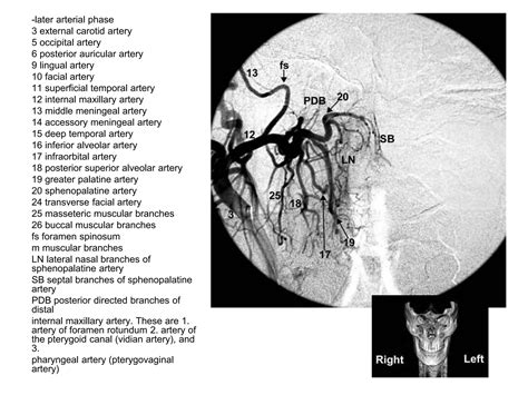 Embolization For Epistaxis Ppt