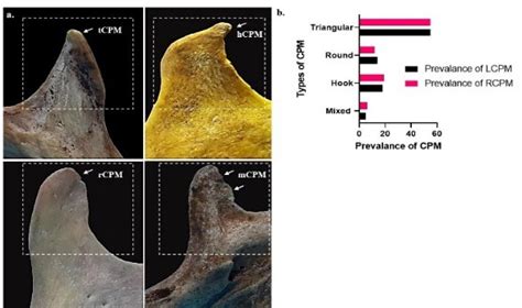 Types Of Coronoid Process Of Mandible A Triangular Cpm Tcpm Type 1