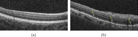 Robust Segmentation Of Retinal Layers In Optical Coherence Tomography