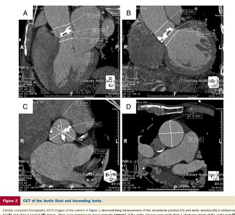 Sinotubular Junction Semantic Scholar