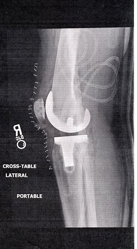 My Experience With Total Knee Replacement Surgery Hubpages