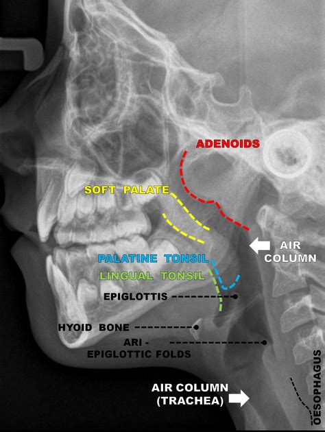 Adenoid Hypertrophy Grading