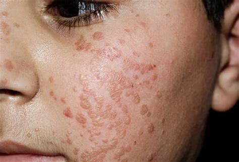 Flat Warts Wart Removal Amd Clinic Johor Bahru