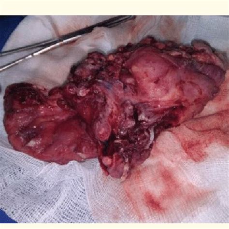 Lower Right Abdominal Mass Scan Suspected Appendicular Mass Download Scientific Diagram