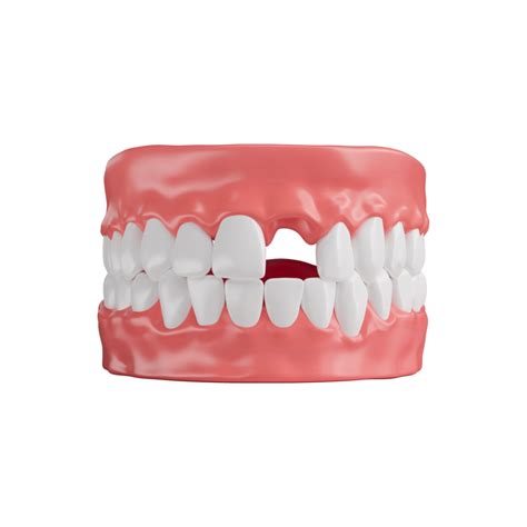 Missing Teeth Perth Belmont Dental Surgery