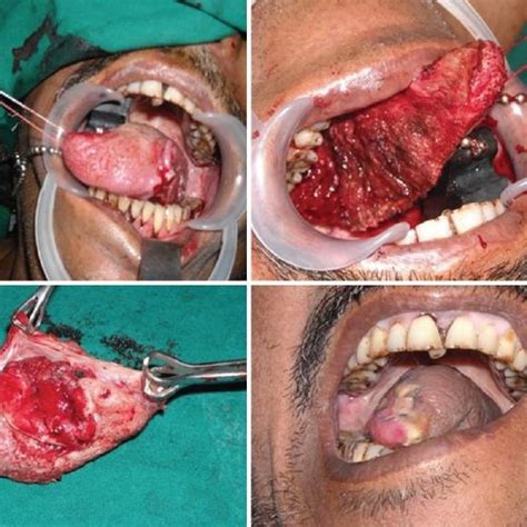 Total Glossectomy With Anterolateral Thigh Free Flap Download