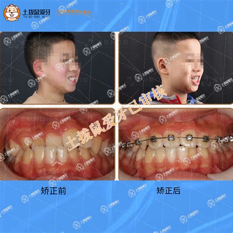 儿童牙齿偏颌矫正案例 土拨鼠爱牙