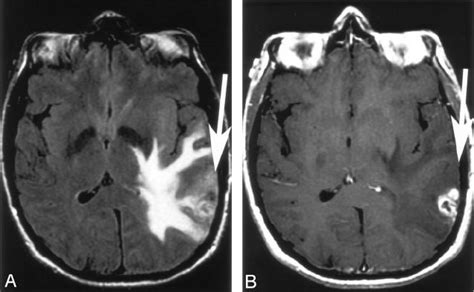 Solitary Enhancing Lesion In The Left Parietal Lobe A And B Axial Download Scientific Diagram