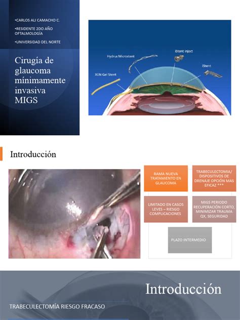 Migs Glaucoma Cac Pdf Glaucoma Medicina