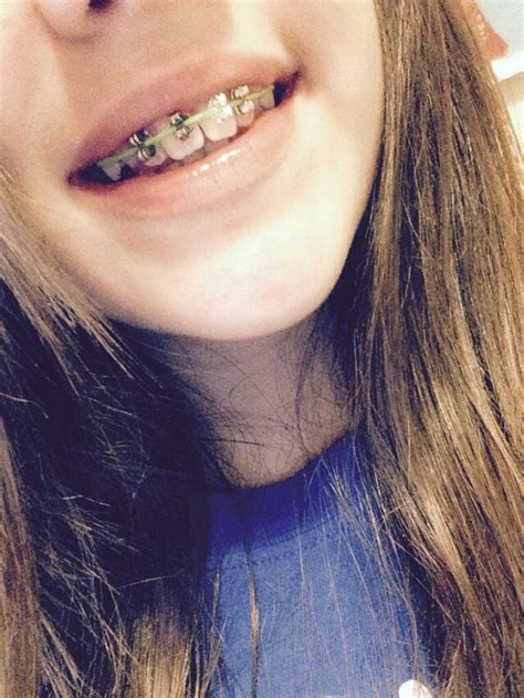 Diy Fake Braces At Paul Harlan Blog