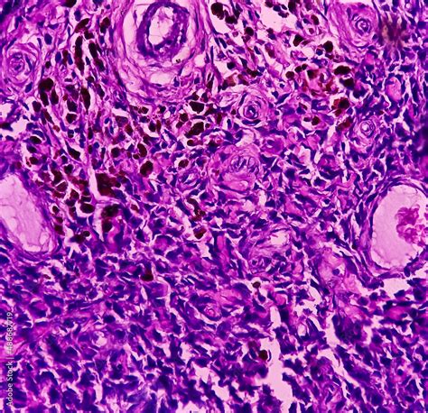 Scapula Cancer Synovial Sarcoma Monophasic Show Malignant Neoplasm Atypical Spindle Shaped