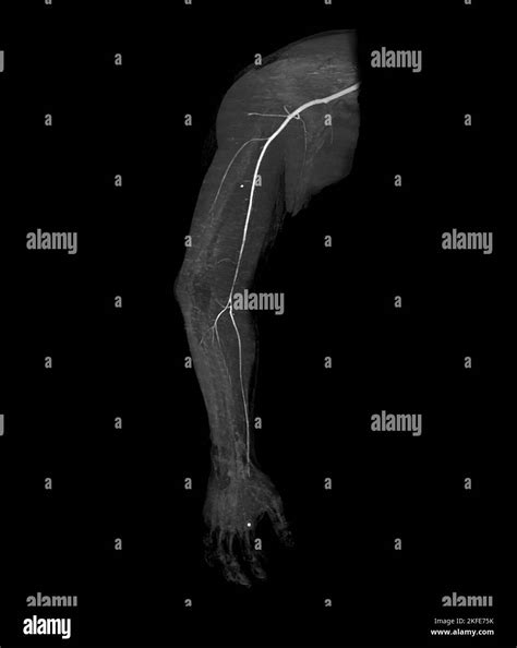 Cta Brachial Artery Or Ct Scan Of Upper Extremity 3d Rendering Image