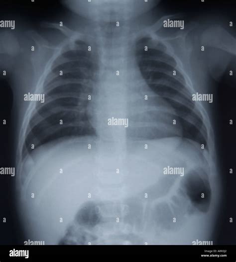 Pediatric Chest View Neonatal Chest Tmhr