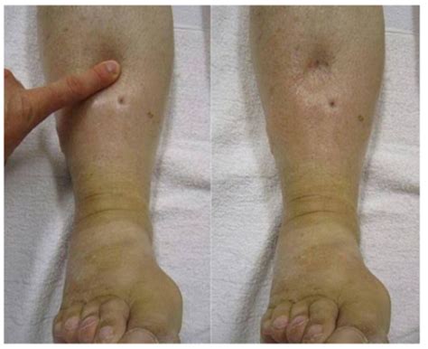 Abnormalities Of The Thyroid Gland Quizlet