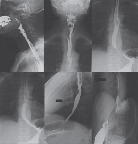 Your Fluoroscopy Swallow University Hospitals Sussex Nhs Foundation Trust