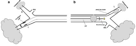 A Right Thoracotomy Steps Place Endotracheal Tube Ett In The
