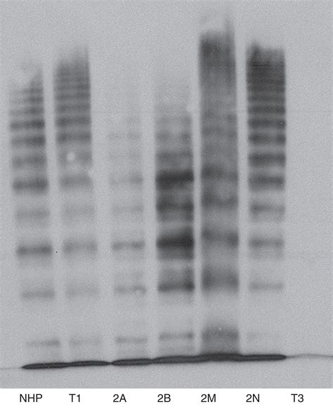 Structure Biology And Genetics Of Von Willebrand Factor Clinical Tree